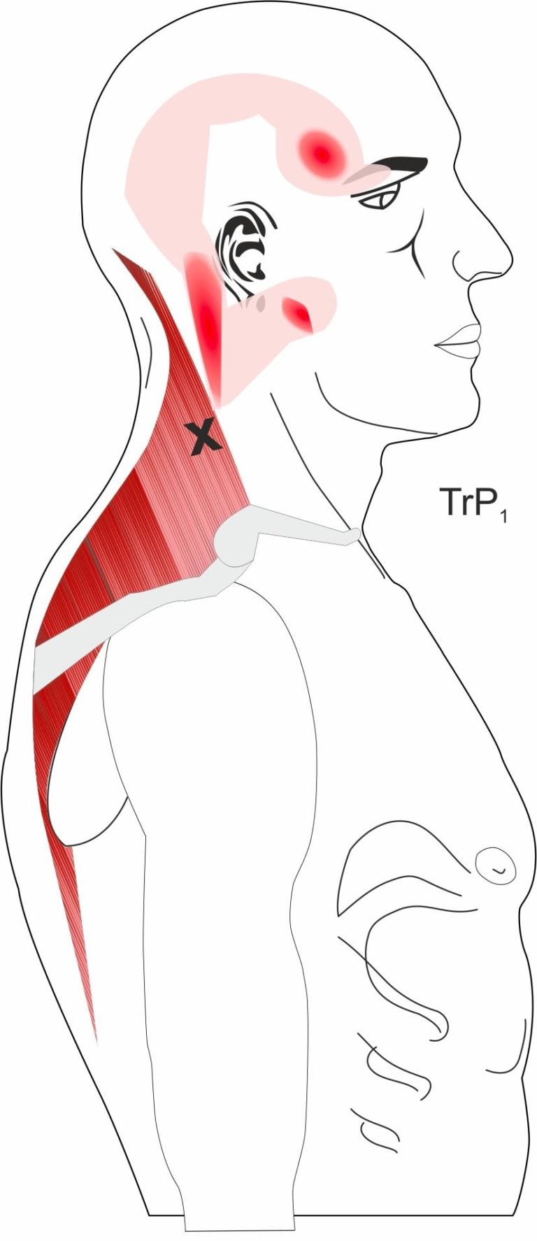 Tension Headaches | Spine Plus