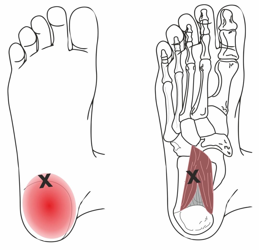 Tendinopathy / Tendonitis | Spine Plus