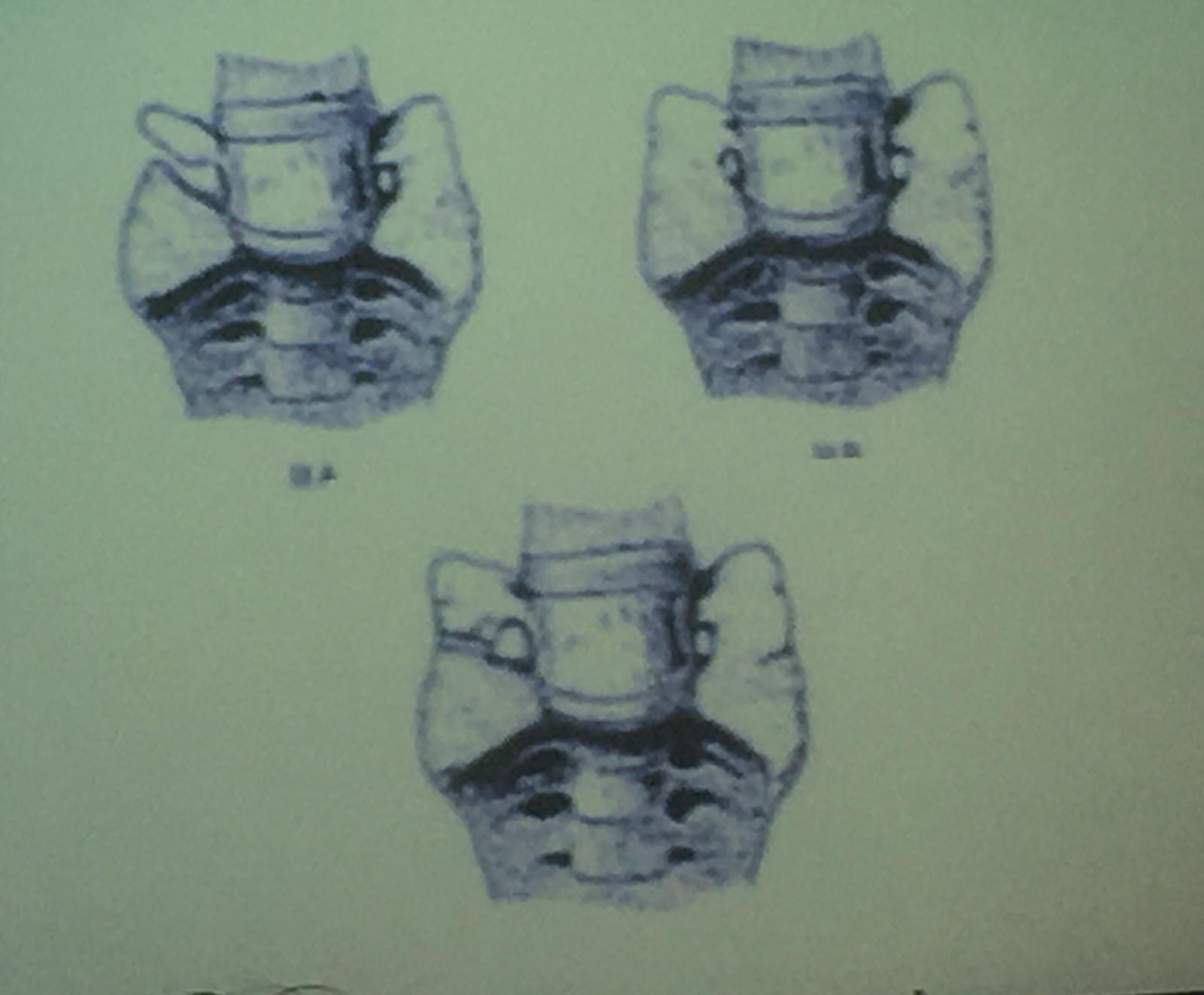 Transitional Lumbosacral Joints | Spine Plus